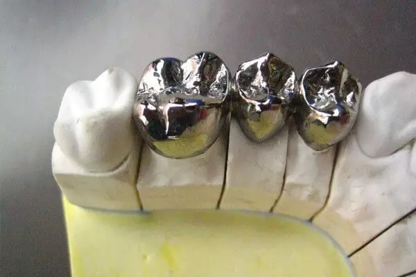 Jauni zobu kroņi. Labākie zobu kroņi – kurus labāk uzstādīt un nepārmaksāt? Plastmasas zobu kroņi